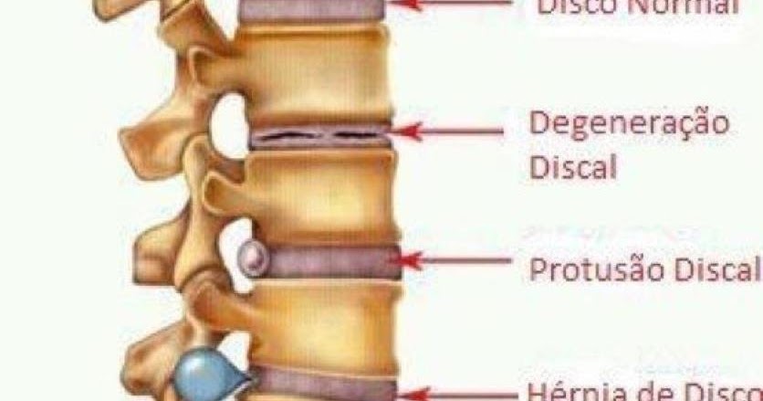 NIPOCLINIC - Eduardo Pinheiro: INFORMAÇÃO (Discos intervertebrais)